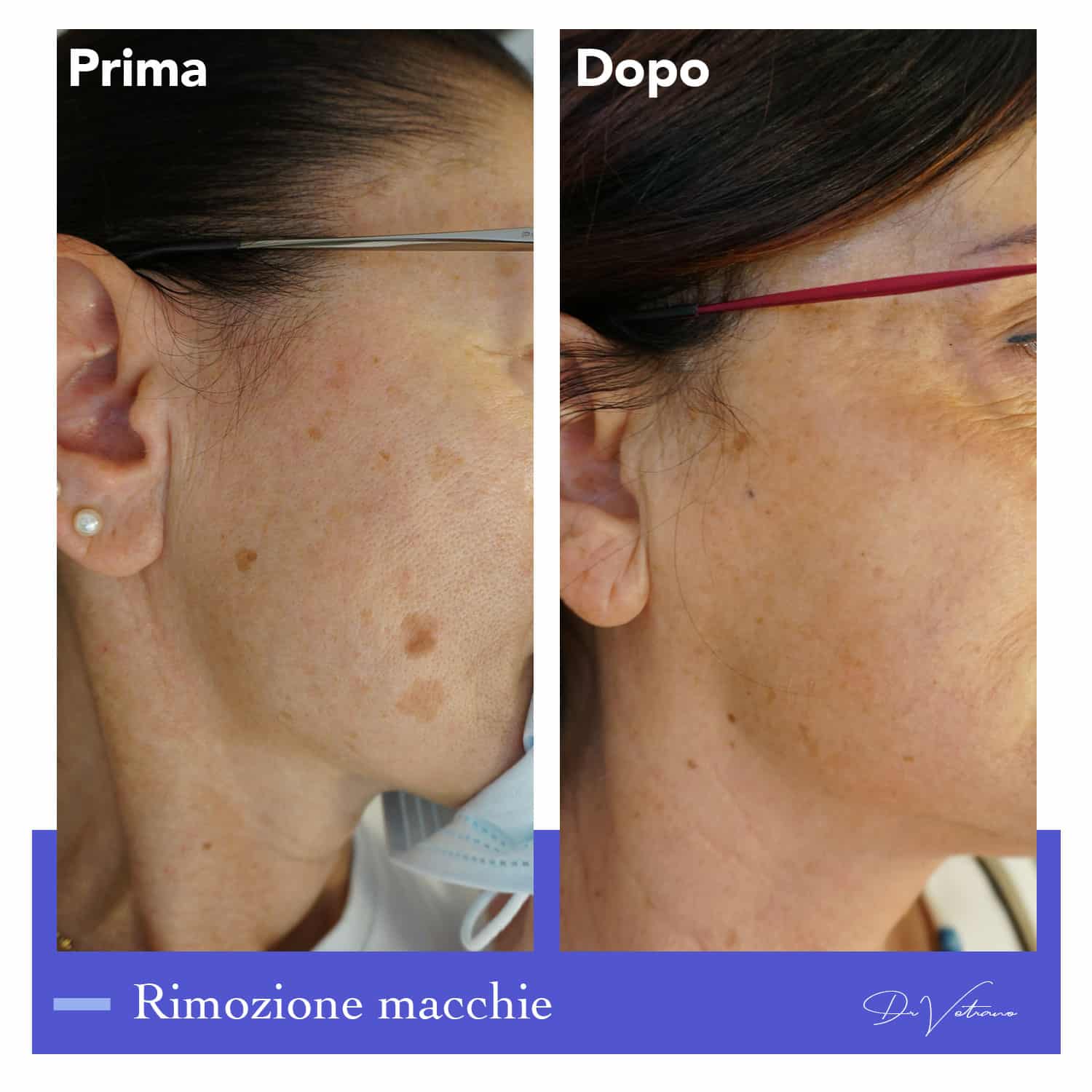 Rimozione macchie - Edoardo Vetrano